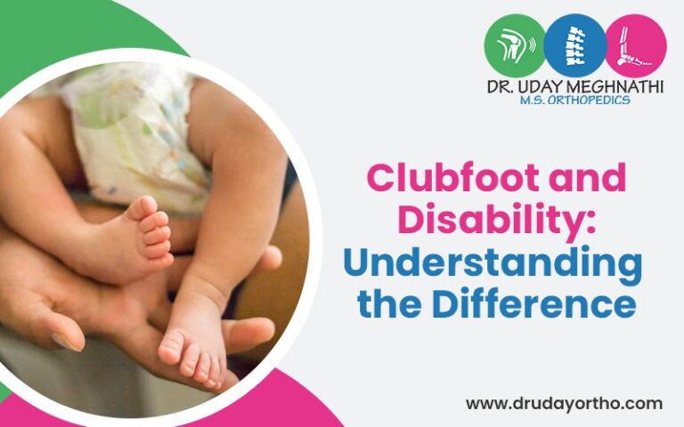 Clubfoot in Newborns: Causes, Types, and Early Detection